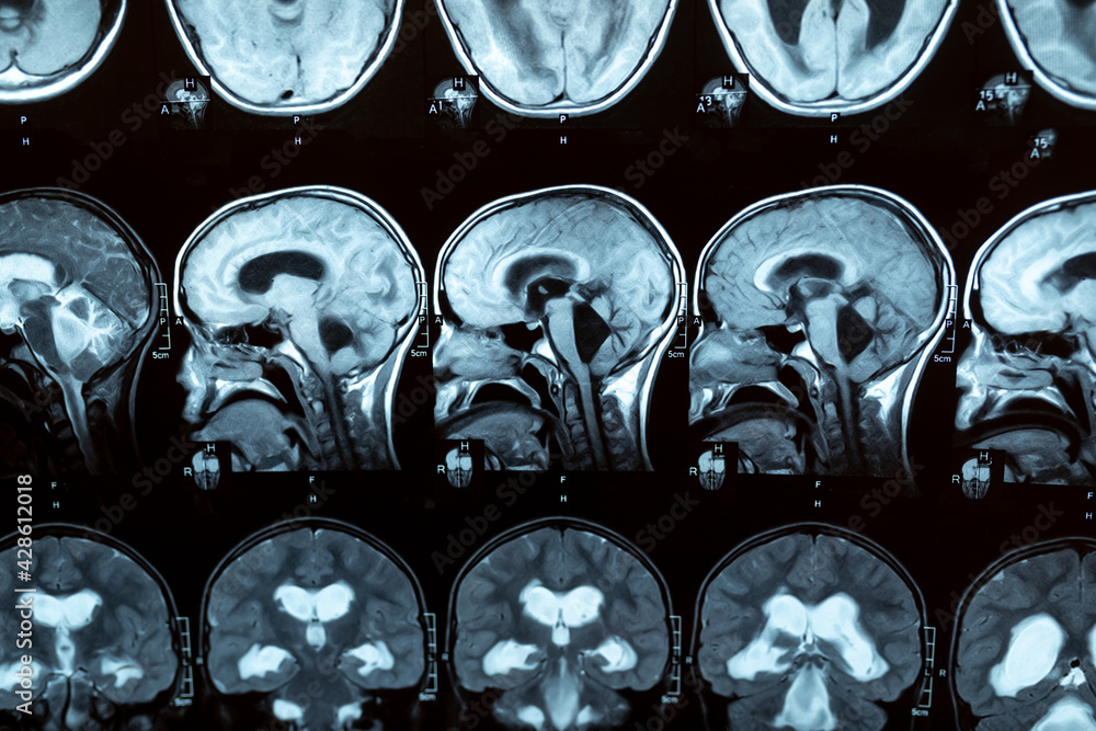 MRI scan or magnetic resonance image of the brain showed obstructive ...