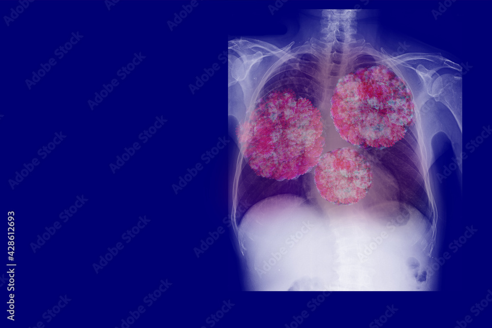 Chest x-ray of a patient showing primary lung cancer in both right and ...