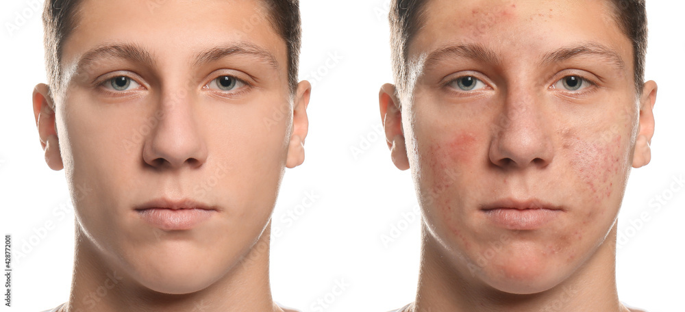 Collage with photos of teen guy with acne problem before and after ...