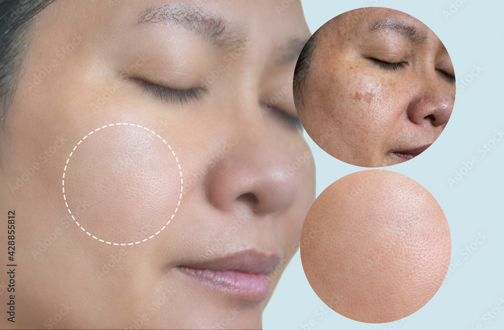 Image before and after spot melasma pigmentation facial treatment on ...