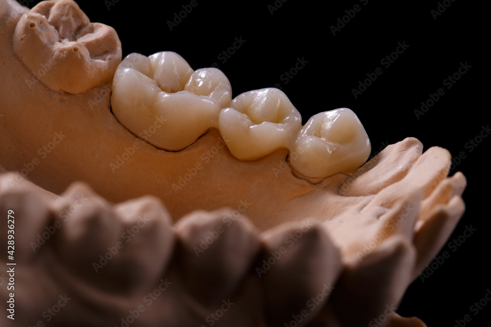 Mold of teeth. Gypsum model plaster of teeth. Stomatologic plaster cast ...
