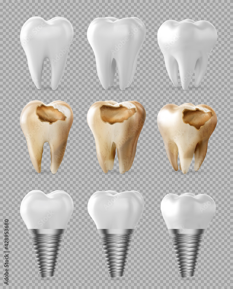 Dental model of a tooth, illustration as a concept of dental ...