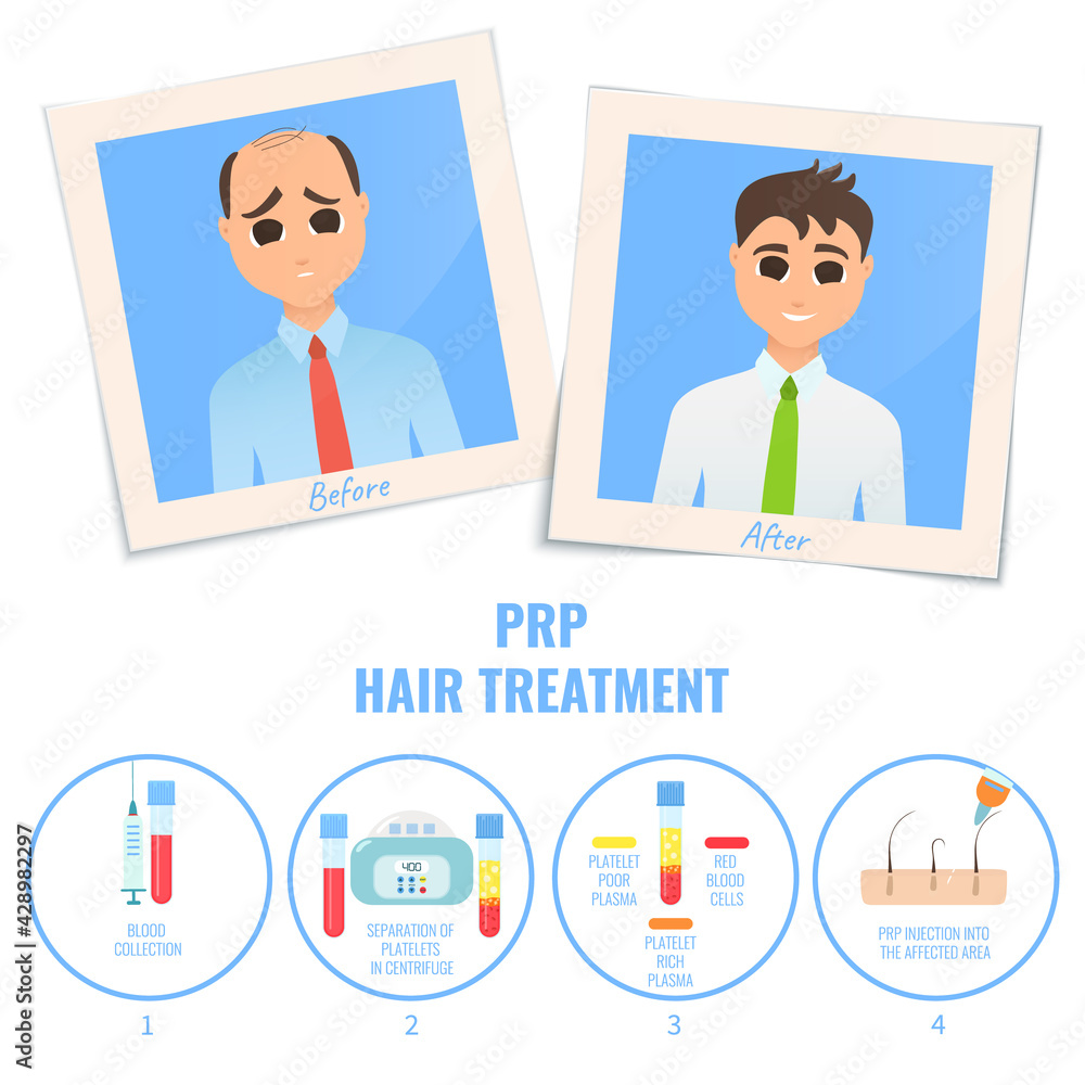 Photographs of a man before and after PRP treatment. Platelet rich ...