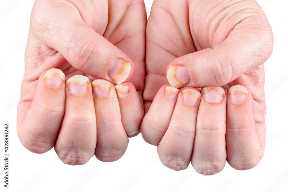 Onychomycosis or fungal nail infection on damaged nails after gel ...