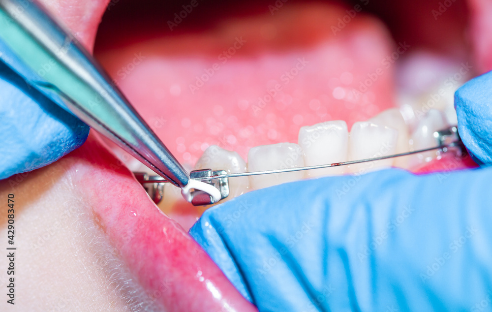 Braces close-up, pulling fixing rubber bands on braces, dentist work ...