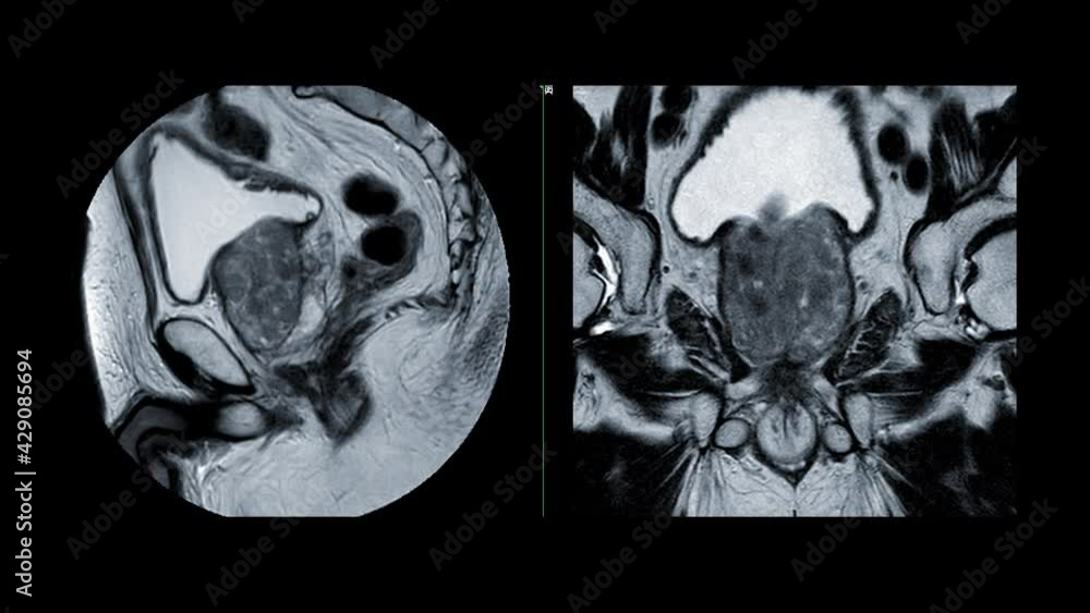 MRI prostate gland Sagittal T2W View for diagnosis prostate cancer cell ...