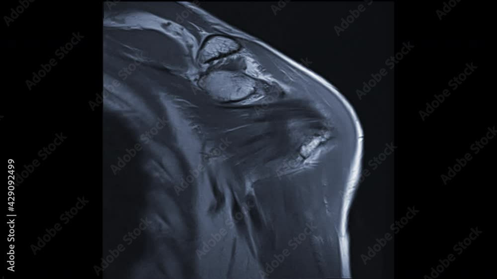 Compare MRI Shoulder joint or Magnetic resonance imaging of Shoulder Joint Coronal T2W and T2W ...