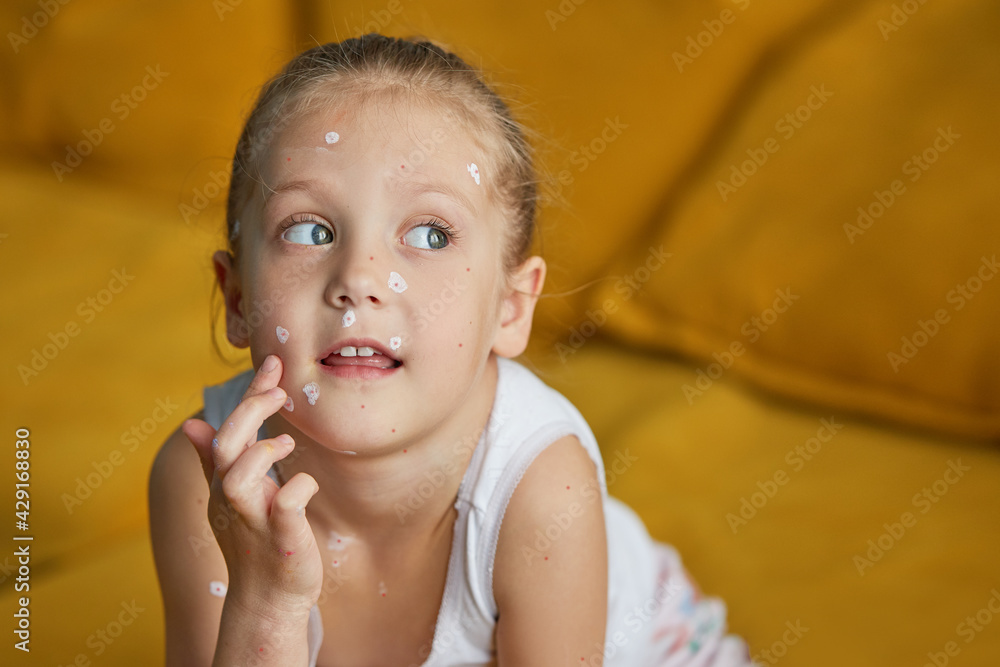 Portrait of smilling little child girl with chickenpox. Sick toddler ...