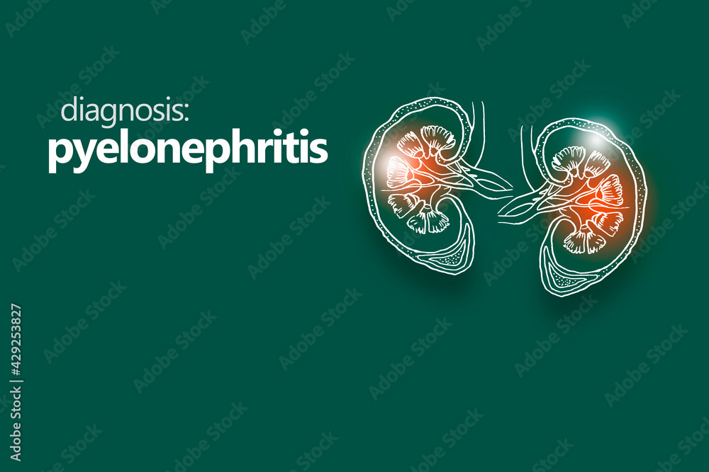 Pyelonephritis, aninflammation of the kidney, typically due to a ...