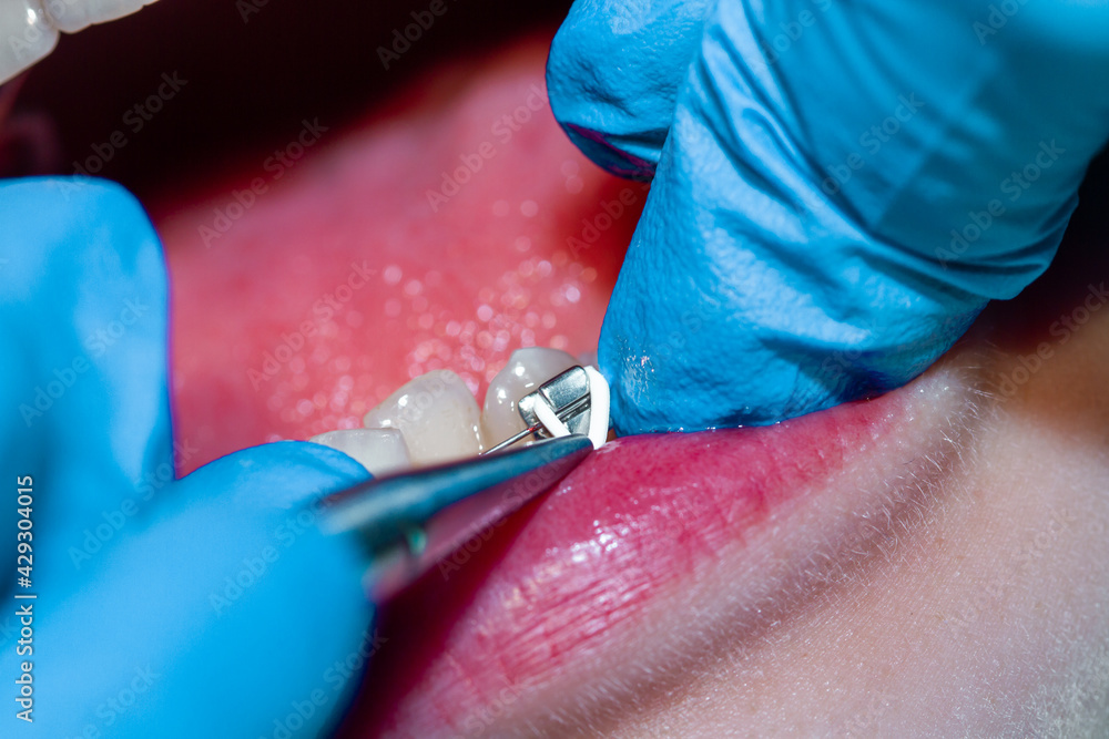 Installation of a metal arch on braces, orthodontics, treatment and ...