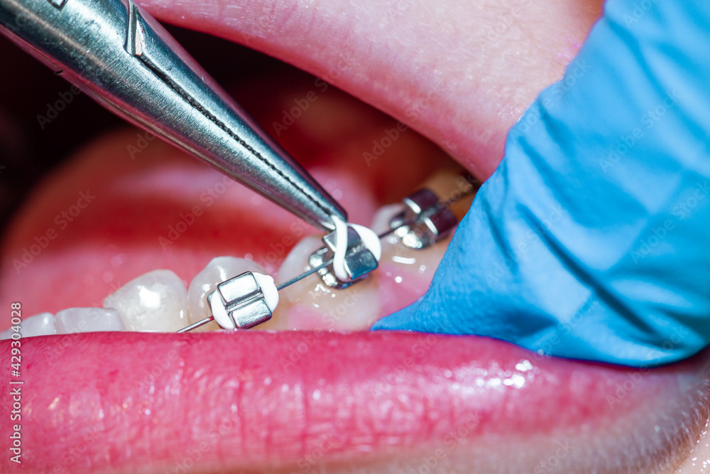 Installation of a metal arch on braces, orthodontics, treatment and ...