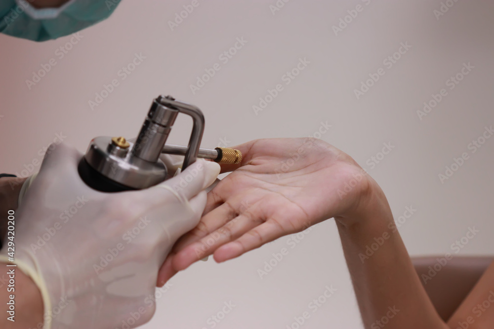 Dermatologists use liquid nitrogen to treat hand warts, Cryotherapy ...