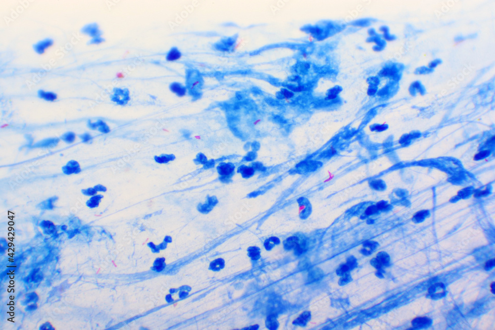 Mycobacterium tuberculosis positive (small red rod) in sputum smear ...