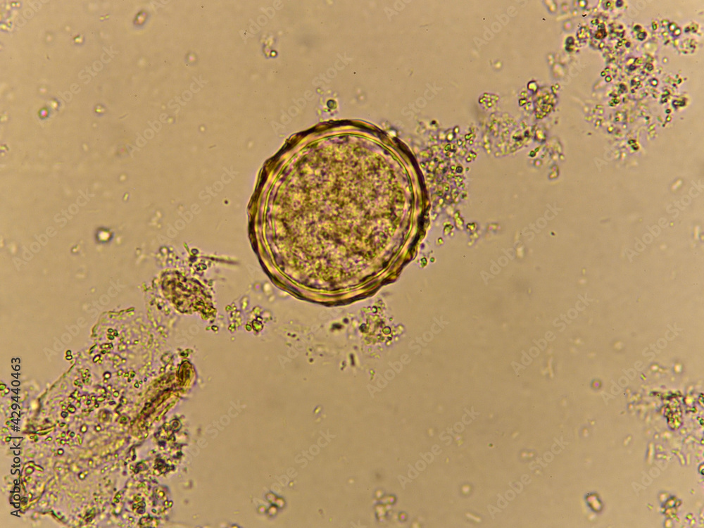 Egg of Ascaris lumbricoides (roundworm) in human stool, analyze by ...