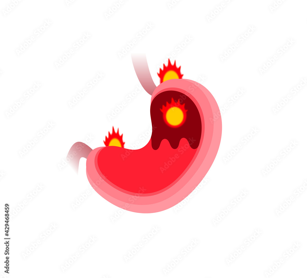 Acid reflux heartburn acidity in stomach vector isolated flat icon acid ...