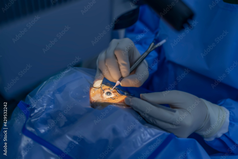 Eye surgery.A patient and surgeon in the operating room during ...