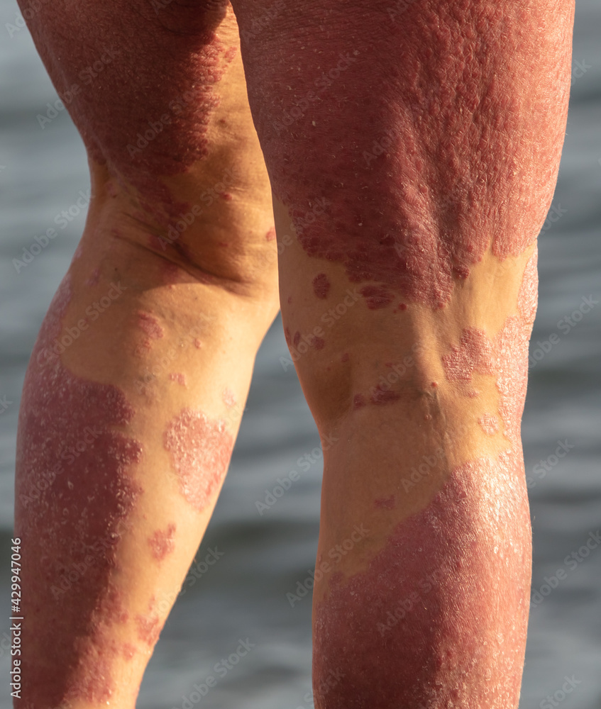 red spots on the legs of a person. Stock Photo | Adobe Stock