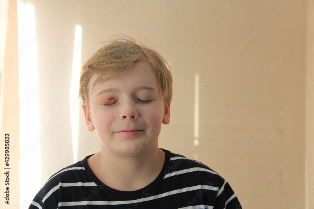 boy with hematoma under eye. haematoma, or blood suffusion. Portrait of ...