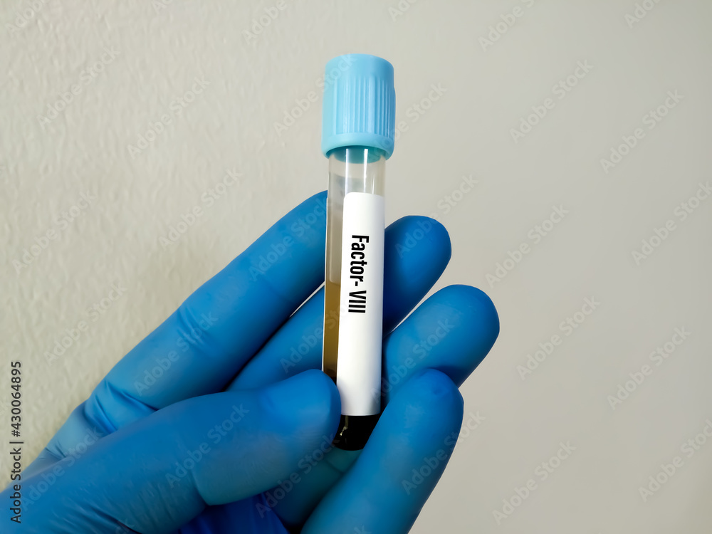Blood Sample for Factor VIII. Blood coagulation testing. Medical or ...