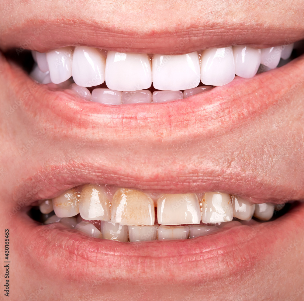 Perfect smile before and after veneers bleach of zircon arch ceramic ...