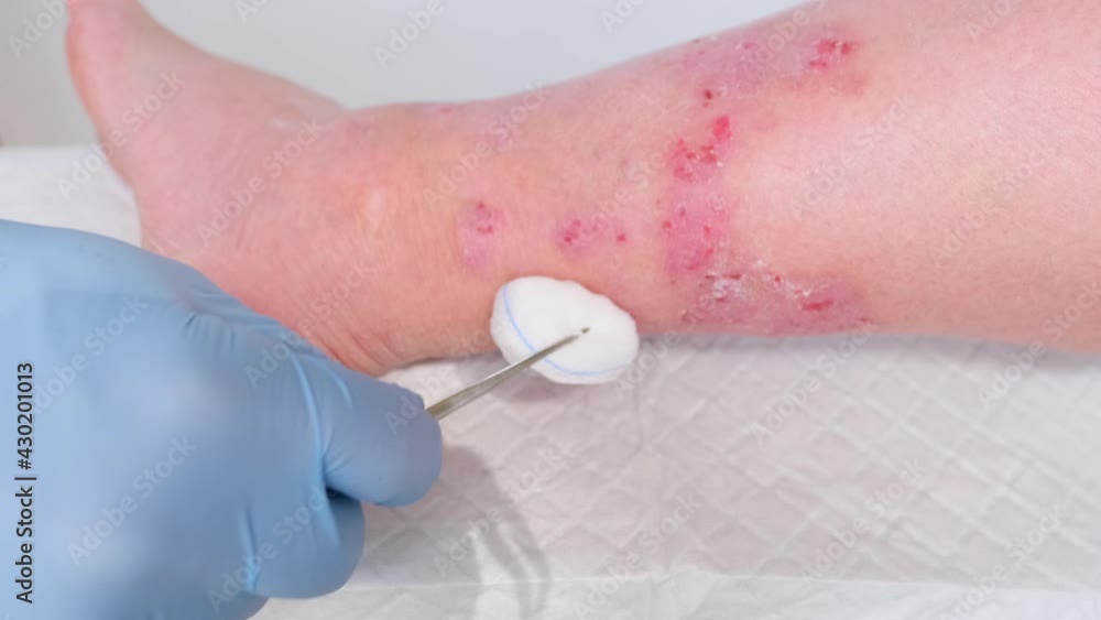 close-up of human shin, doctor treats numerous wounds on leg of an ...