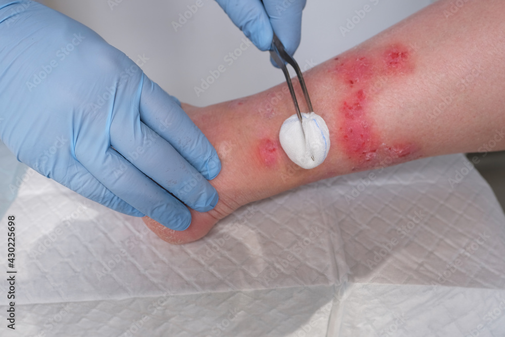 close-up of human shin, doctor treats numerous wounds on leg of an ...