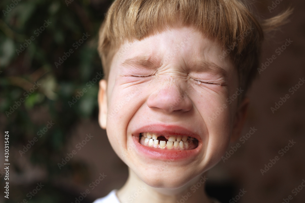 Portrait of crying little boy with closed eyes with open mouth without one front tooth. Lost or ...