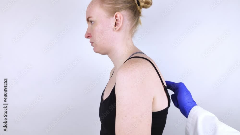 Kyphosis. The woman suffers from a curvature of the spine in the upper ...