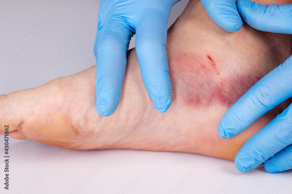 Doctor is examining an injured foot with bruise and scratch. Bruise on ...