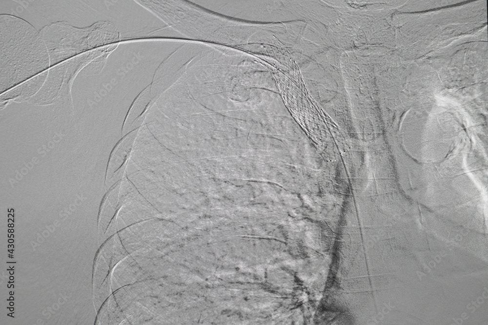 Angioplasty, balloon angioplasty and percutaneous transluminal ...
