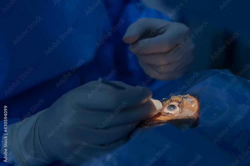 Foto de Phacoemulsification, destruction of the opaque lens by ...