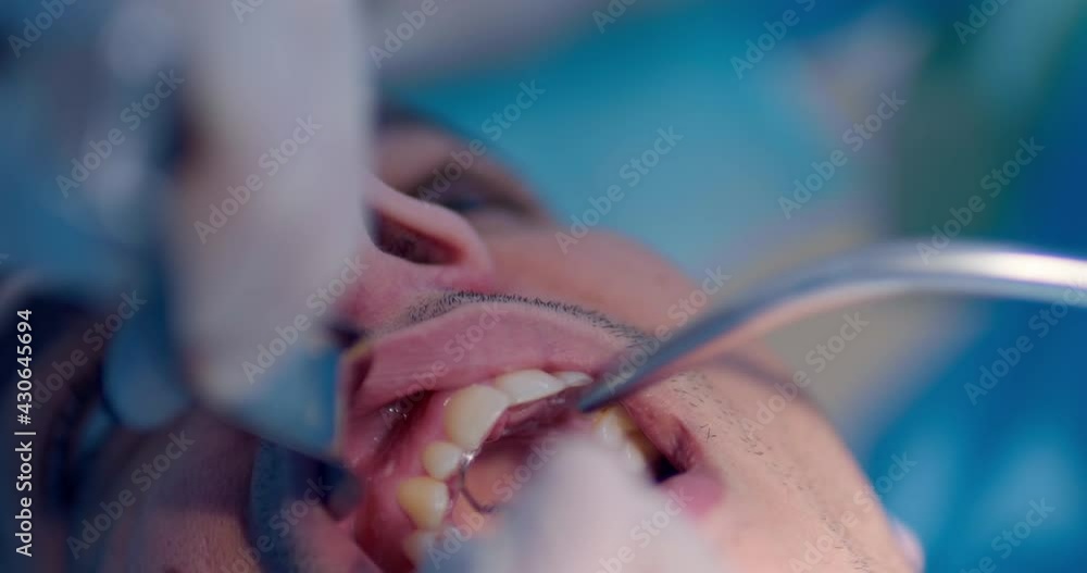 Close-up face a male patient with an open mouth who is having teeth ...