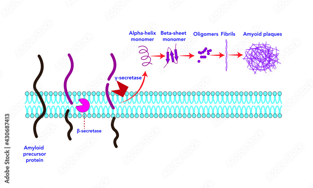Amyloid plaque formation [Alzheimer] 素材庫向量圖 | Adobe Stock