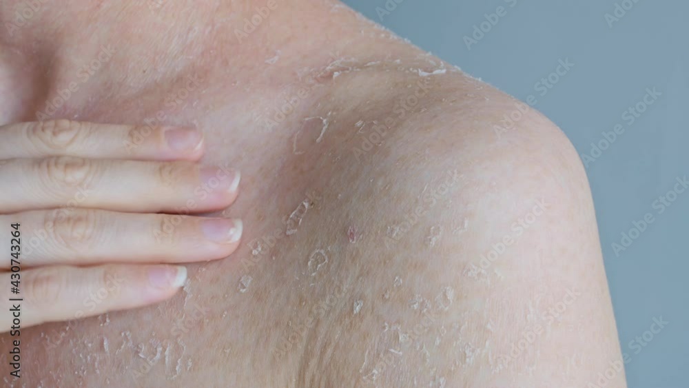 A woman scratches the skin on her shoulder with her nails, which is ...
