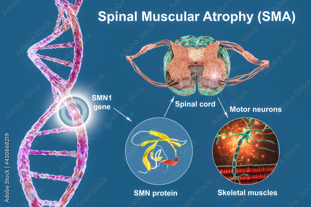 Spinal Muscular Atrophy Sma A Genetic Neuromuscular Disorder With