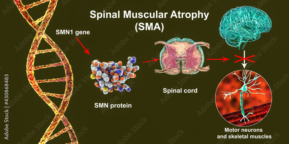 Spinal muscular atrophy, SMA, a genetic neuromuscular disorder with ...