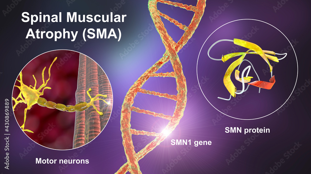 Spinal muscular atrophy, SMA, a genetic neuromuscular disorder with ...