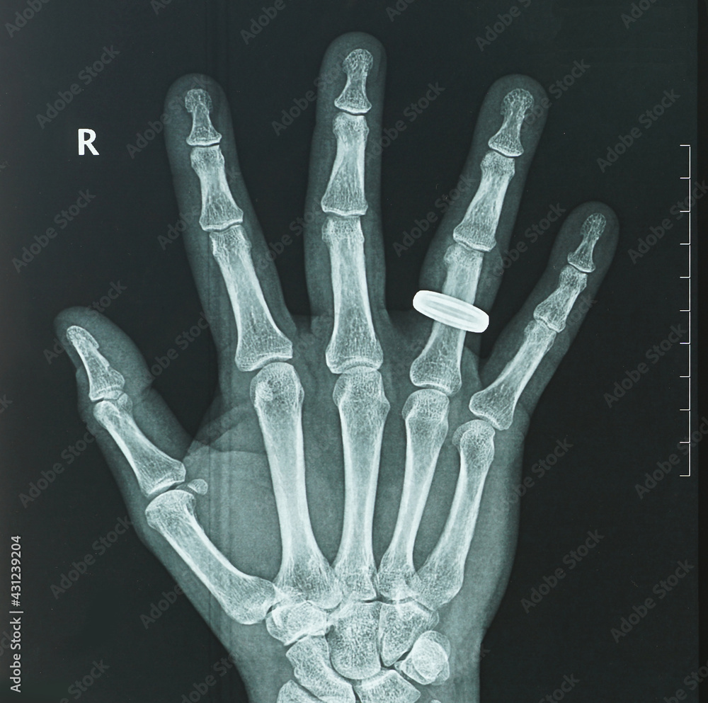 X-ray of the right hand of an adult with a suspected fracture of the ...