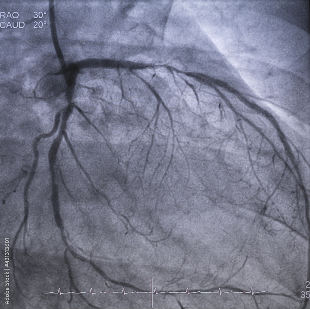Foto de Coronary angiogram (CAG) was performed left anterior descending ...