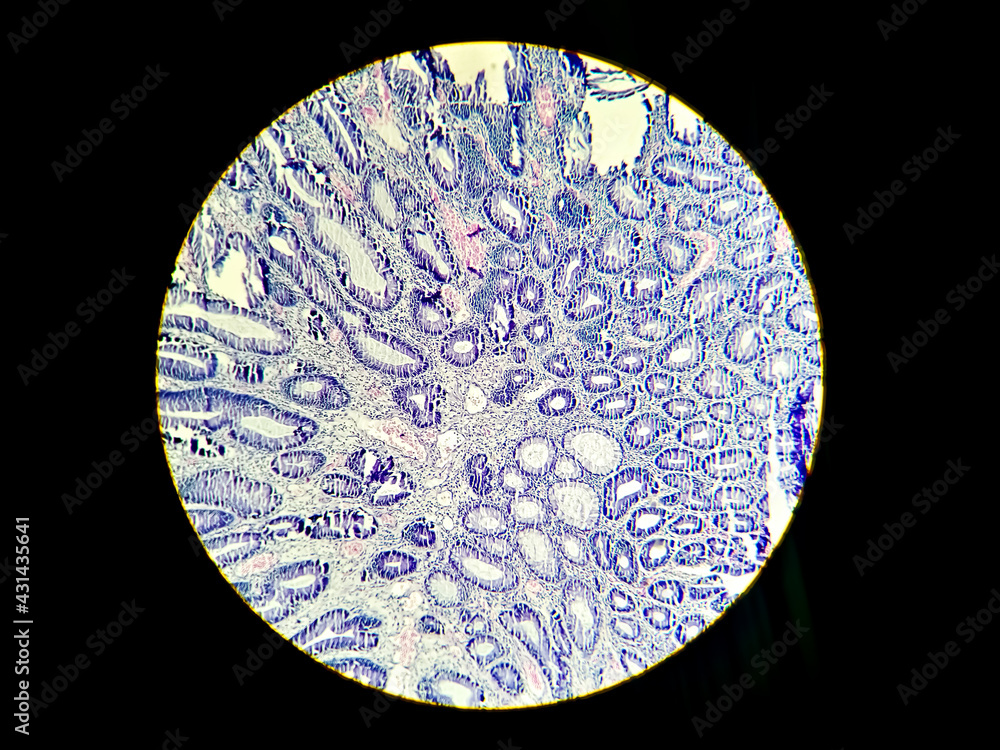 Colon Cancer: Photomicrograph (microscopic image) of colonic ...