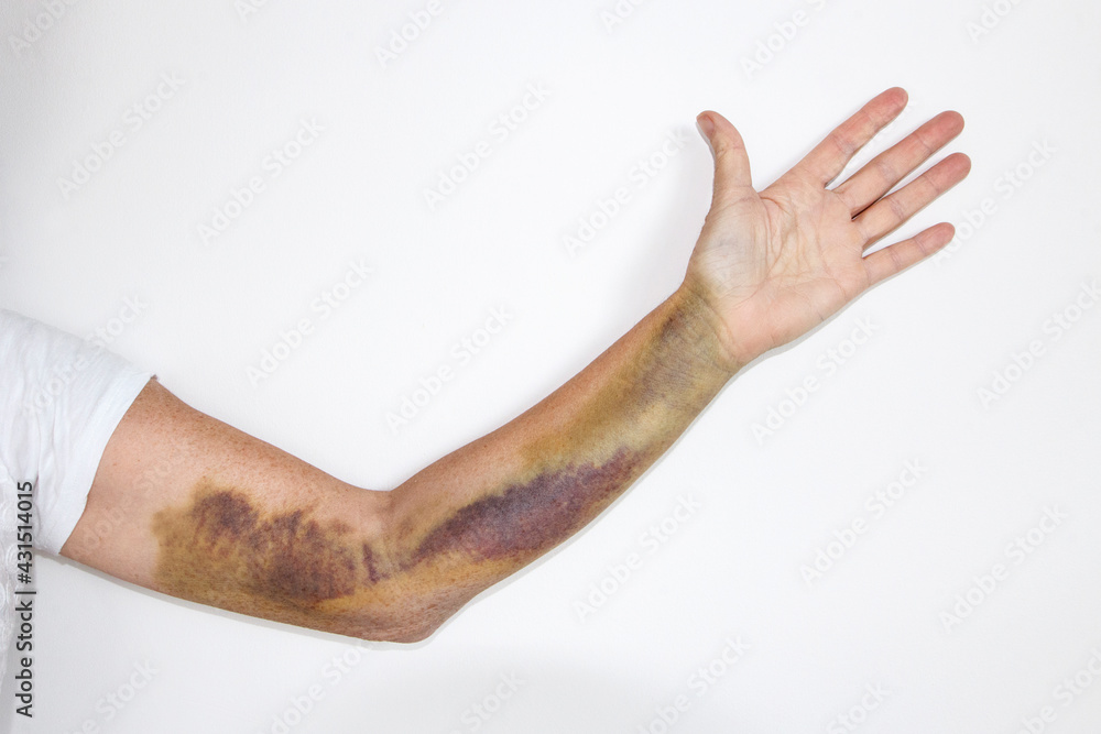 Intense bruising from a dislocated elbow joint, break of the olecranon ...