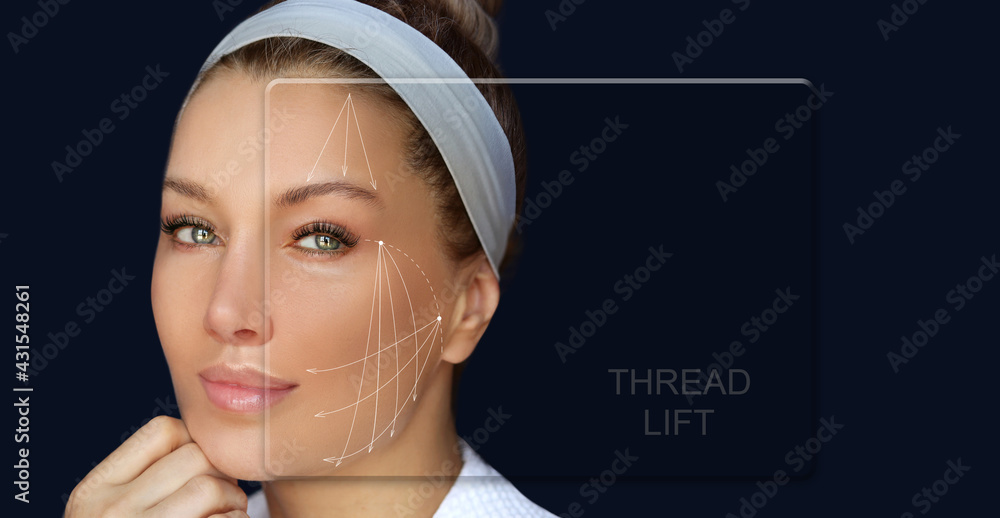 thread lift procedure ,non-surgical facelift,markup Stock Photo | Adobe ...