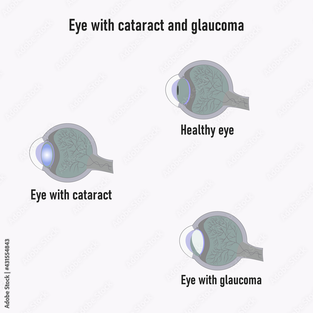 Glaucoma eye. Development of Glaucoma. The structure of the eye ...