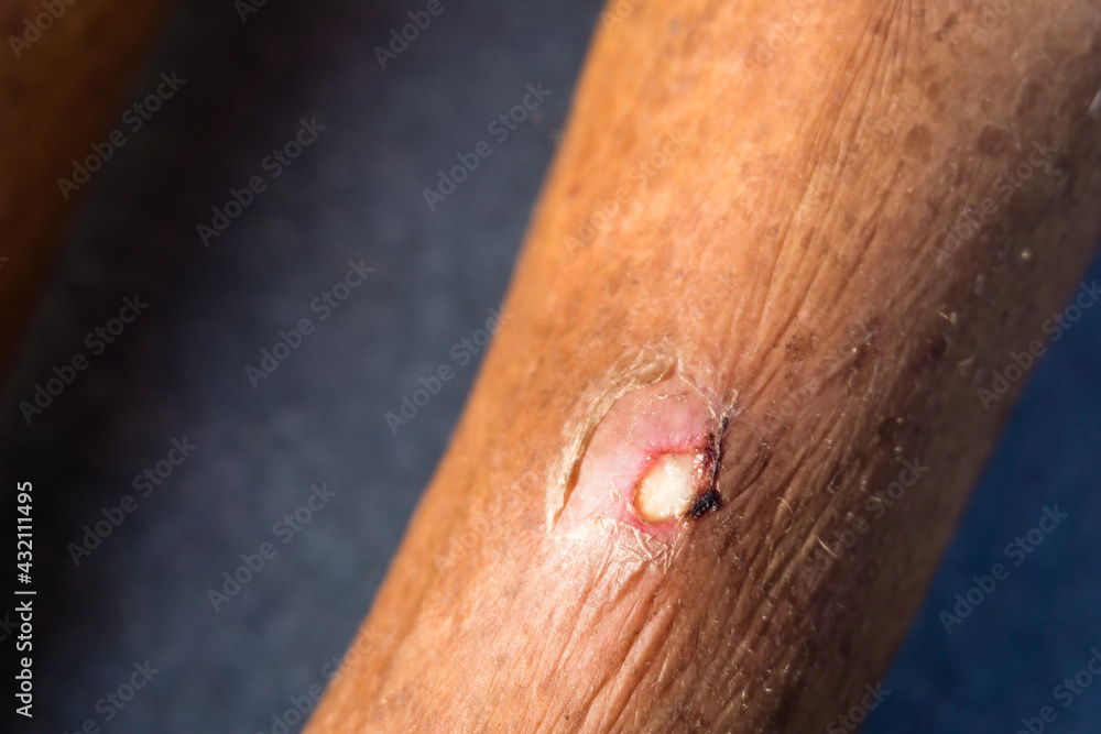 A close up shot of an infected boil filled with pus inside on the leg ...