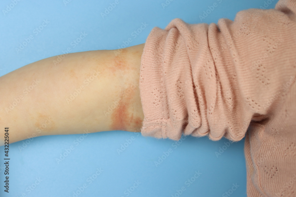 rash on the crease of a child's arm close-up, atopic dermatitis, or ...