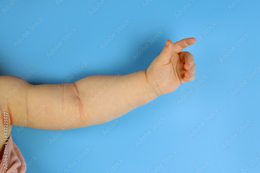 rash on the crease of a child's arm close-up, atopic dermatitis, or ...
