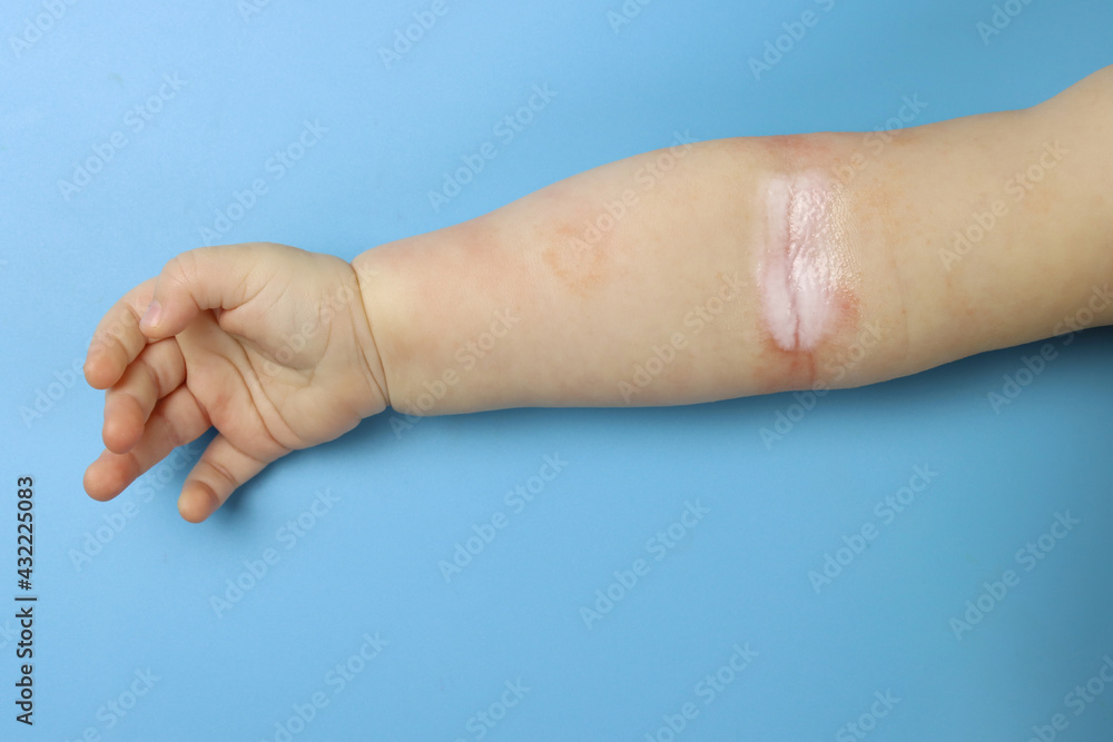 hand of a newborn baby with red skin smeared with ointment medicine ...