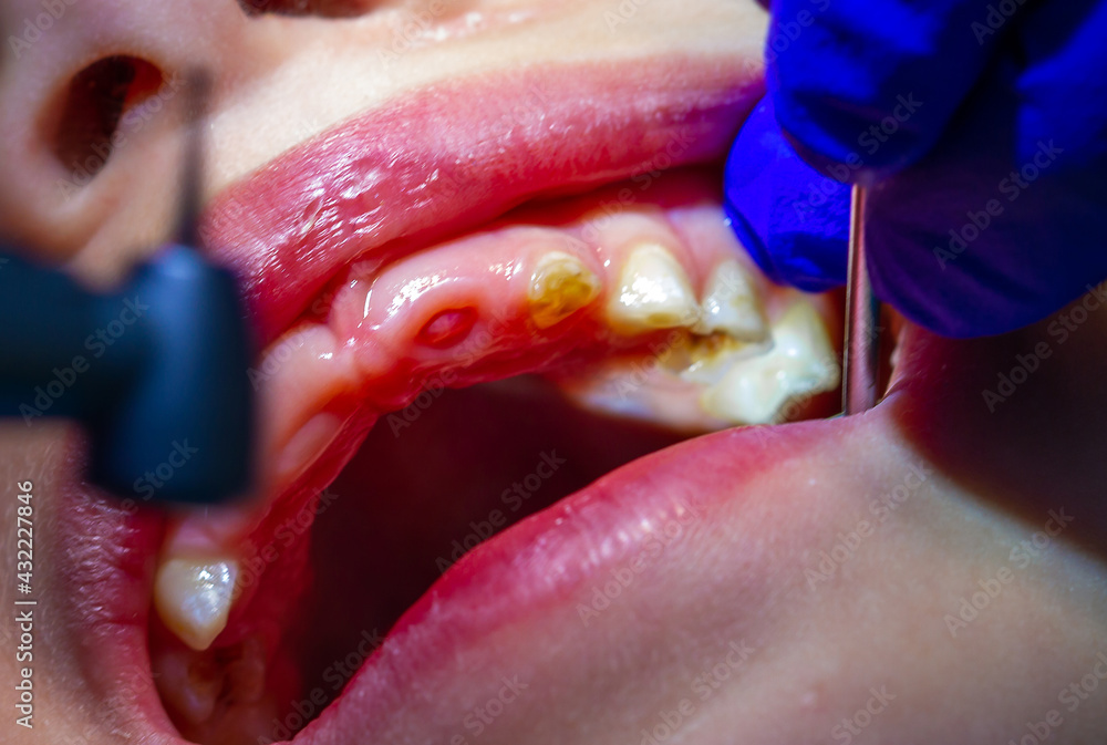 Treatment and filling of milk teeth, a child at the dentist, treatment ...