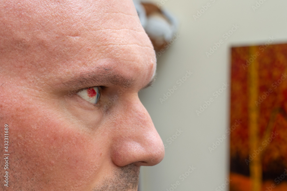 A close up of a subconjunctival hemorrhage red blood spot in a ...