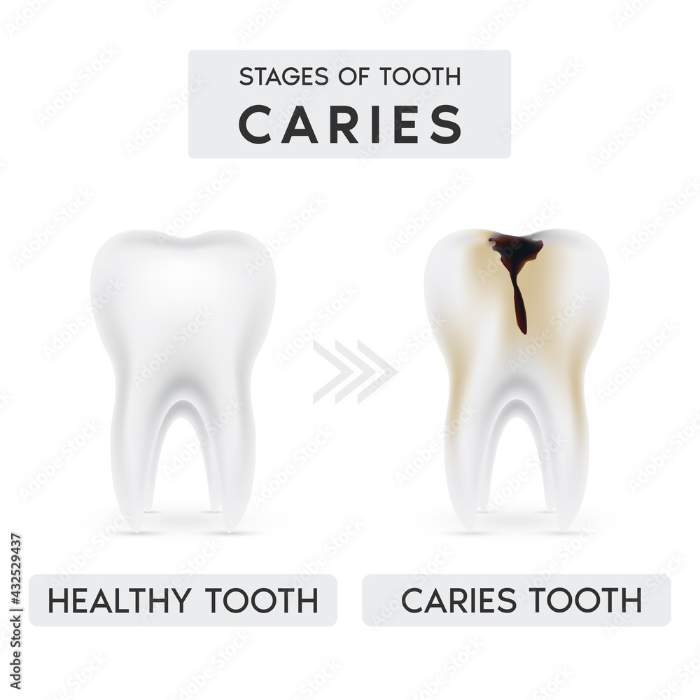 Tooth caries structure and Progression and Treatment: Dental ...